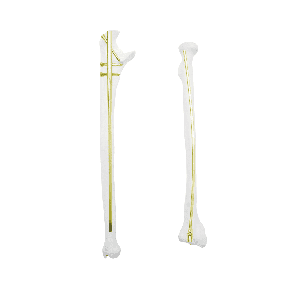 QML Multi-Dimensional Ulna & Radius Intramedullary Nail System • Kangli Orthopedics